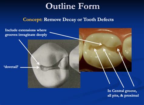 Flashcards Class Ii Amalgam Design Quizlet