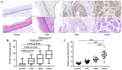 Stat1 Expression In Cervical Tissues A Immunohistochemical Staining