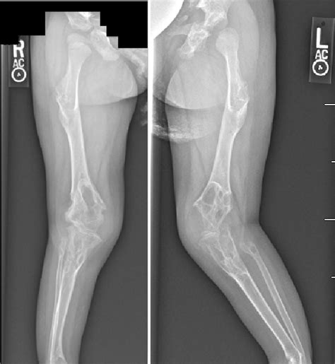 Lower Extremity Radiographs Demonstrating Acetabular Dysplasia Coxa Download Scientific