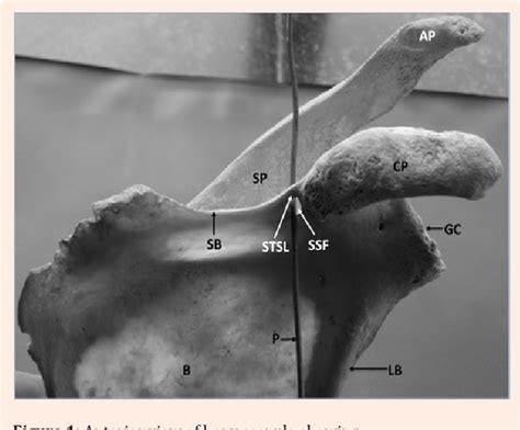 Figure 1 From Anomalous Suprascapular Foramen In Adult Indian Scapula