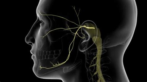 Trigeminal Neuralgia Vascular Loop