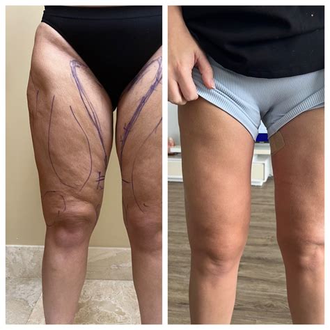 Scarless Thigh Lift Explained No Scars Just Results Vegas Liposuction