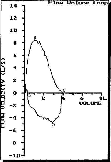 Normal Flow Volume Curve Of A Patient With Vocal Cord Dysfunction Download Scientific Diagram
