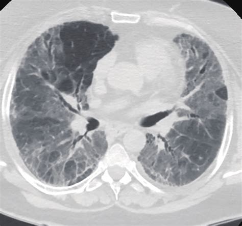 preoperative high resolution computed tomography scan of the chest
