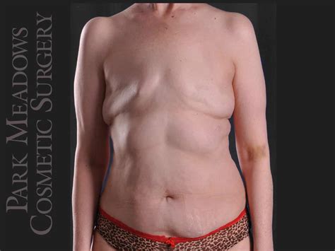 Delayed Breast Reconstruction After Mastectomy Archives