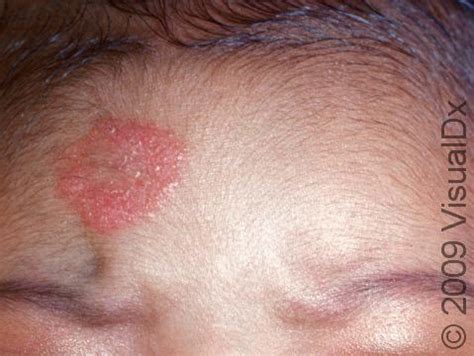 Tinea Circinata In Face