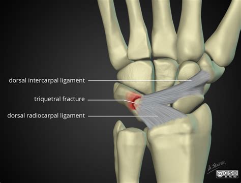 Triquetral Fracture Pacs