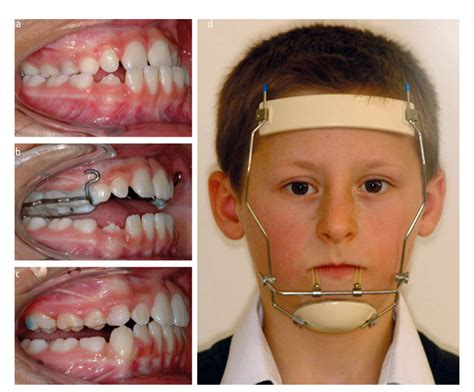 Early Orthodontic Treatment For Class Iii Malocclusions