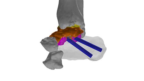 Lrs Helps Two Patients In Israel Metalworking News