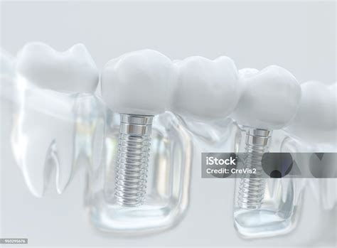 치과 브릿지3d 렌더링 임 플 란 트 가나에 대한 스톡 사진 및 기타 이미지 가나 강철 건강관리와 의술 Istock