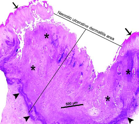 Histopathological Appearance Of Necrotic Ulcerative Dermatitis Normal