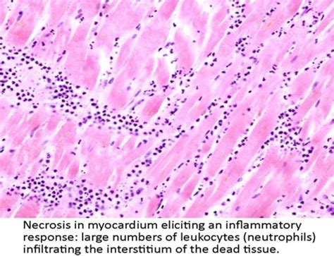 Lecture 4 Cell Injury 2 Flashcards Quizlet
