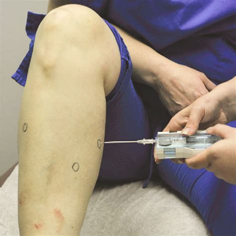 Chronic Exertional Compartment Syndrome Everis