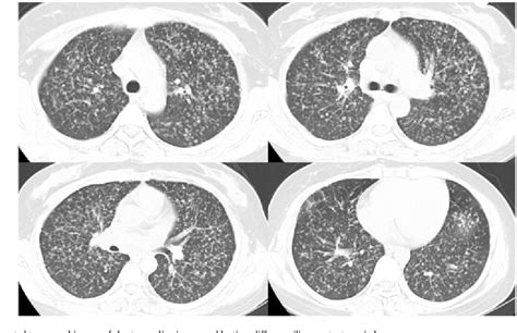 Figure 1 From Miliary Metastases In Lung Cancer Semantic Scholar