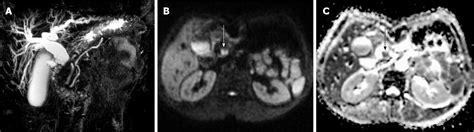 Figure 1 From Role Of Diffusion Weighted Magnetic Resonance Imaging In The Diagnosis Of