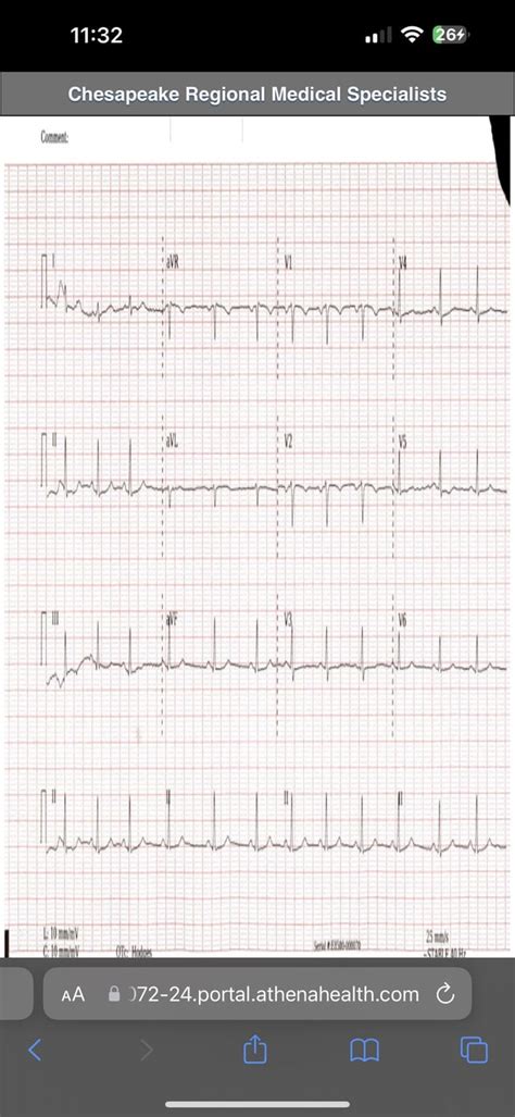 24 female prior normal ecgs but this is the most recent r readmyecg