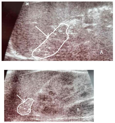 Primary Adrenal Insufficiency Complete Sex Reversal And Unique