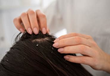 Dandruff Removal Treatment Scalp Peel Treatment In Mumbai PHI Clinics