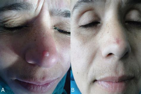 Intradermal Nevus Removal