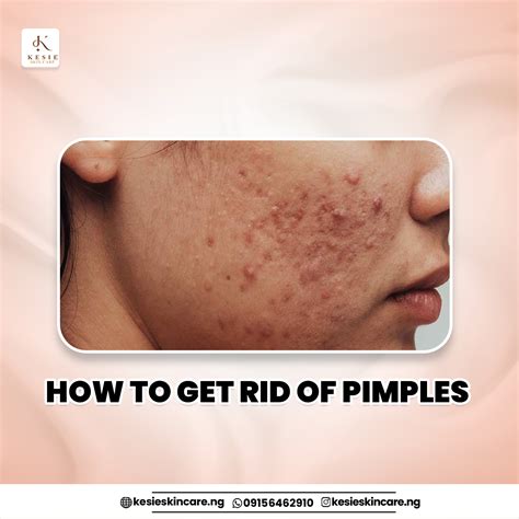 How To Get Rid Of Pimples Kesie Skincare