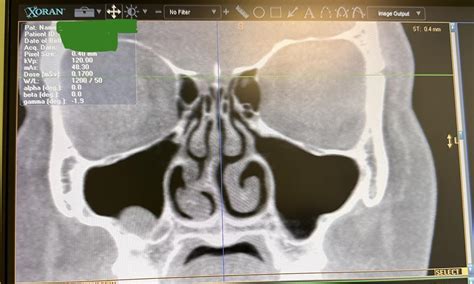 Does Deviated Septum Surgery Increase Quality Of Life Rsinusitis