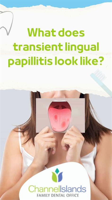 Transient Lingual Papillitis Guide Xxpe