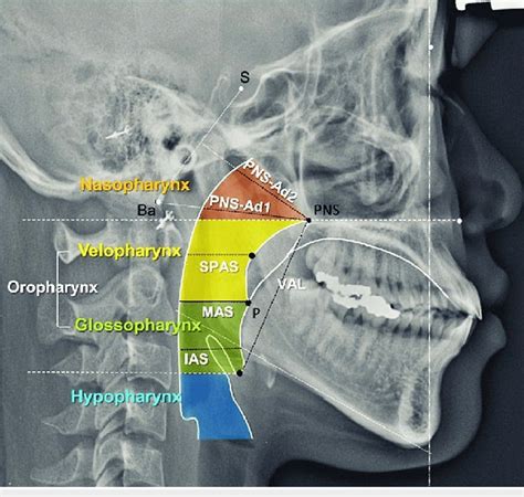 Demonstration Of Cephalometric Pharyngeal Evaluation To Illustrate Each