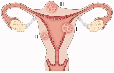 Three Types Of Myomectomy Scar Pregnancy Download Scientific Diagram