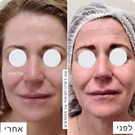 אנגל מרכז לטיפולי עור מתקדמים