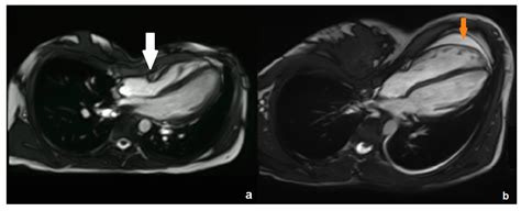Cardiac Magnetic Resonance Imaging With Myocardial Strain Assessment