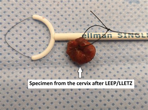 Loop Electrosurgical Excision Procedures At Krista Guerrero Blog