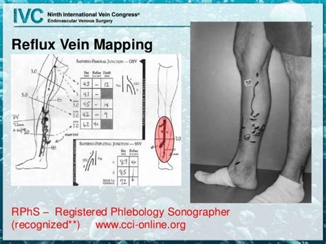 Leg Venous Mapping