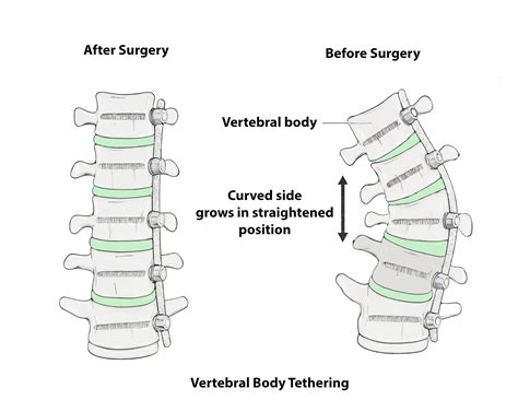 Adolescent Idiopathic Scoliosis Treatment Qusai Hammouri Md
