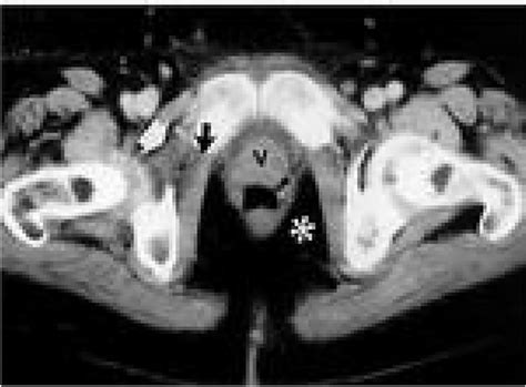 Normal Perianal Anatomy [caption] Ct Scan Through The Female Download Scientific Diagram