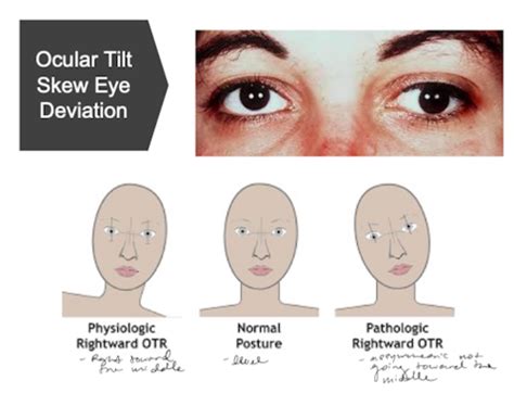 Skew Deviation And Ocular Tilt Reaction Flashcards Quizlet