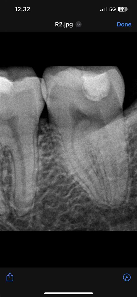 Does This Require A Filling Dentist Said Its Just A Shadow Raskdentists