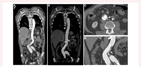 Computed Tomography Angiography Studies Of Abdominal Aorta Disease A
