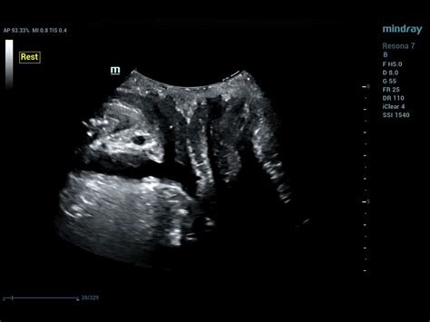 Urogynecology Mindray Women Healthcare Solution Mindray