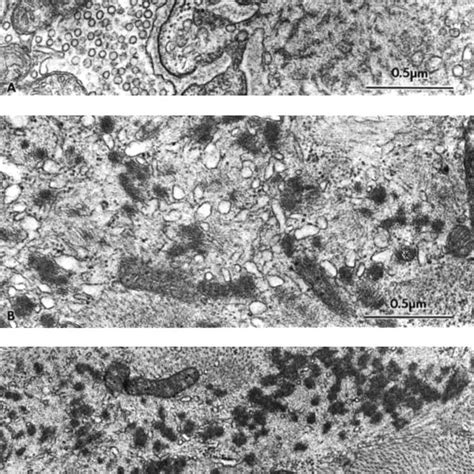 Myofibrillar Disarrangement The Asterisk I Indicates Disarray Of