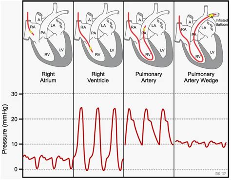 Right Heart Catheterization Asian Heart And Vascular Center