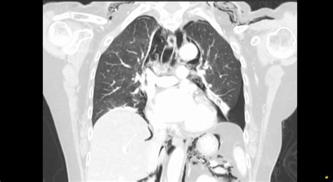 Benign Extensive Pneumothoraces Pneumomediastinum Pneumoperitoneum Pneumoretroperitoneum And