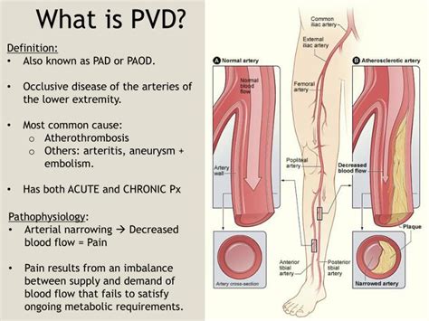 Ppt Peripheral Vascular Disease Acute And Chronic Limb Ischemia Powerpoint Presentation Id 676959