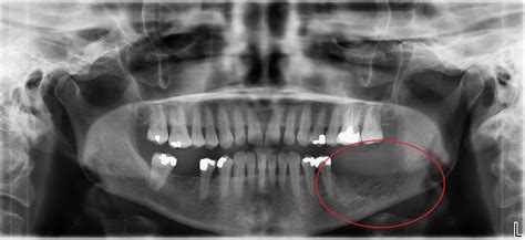 Tooth Extraction Without X Ray At Cynthia Goldsmith Blog