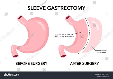 Vertical Sleeve Gastrectomy Surgery Medical Vector Stock Vector Royalty Free 2487525615