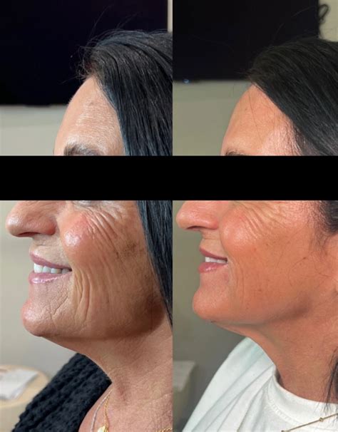 Moxi And Bbl Heroic Before And After Images Lou Lou Med Spa