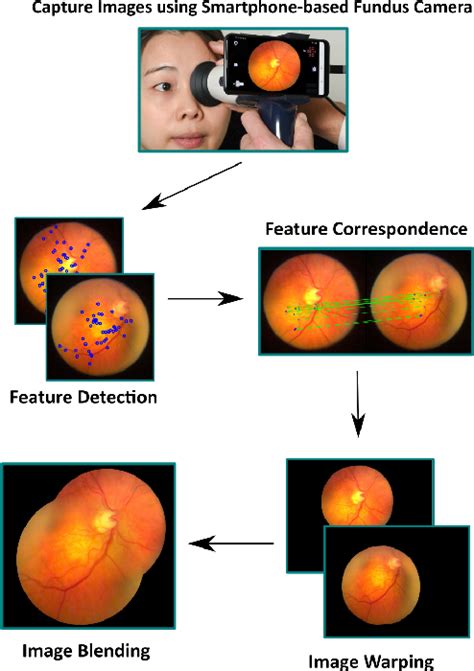 Figure 1 From Multi Image Stitching For Smartphone Based Retinal Fundus Stitching Semantic Scholar