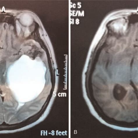 Mri Showing A 75 Â 50 Â 50 Cm Sized Cystic Solid Mass In The In The