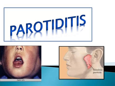 Parotiditis Taller De Salud Y Ambiente Pptx