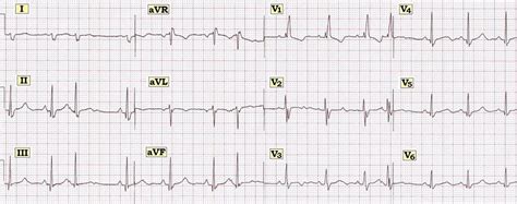 Bifascicular Block Ecg Book