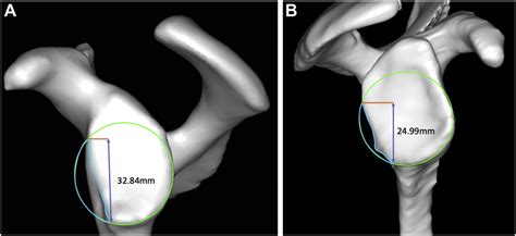 Superior To Inferior Measurement Of The Bony Defect By Utilizing